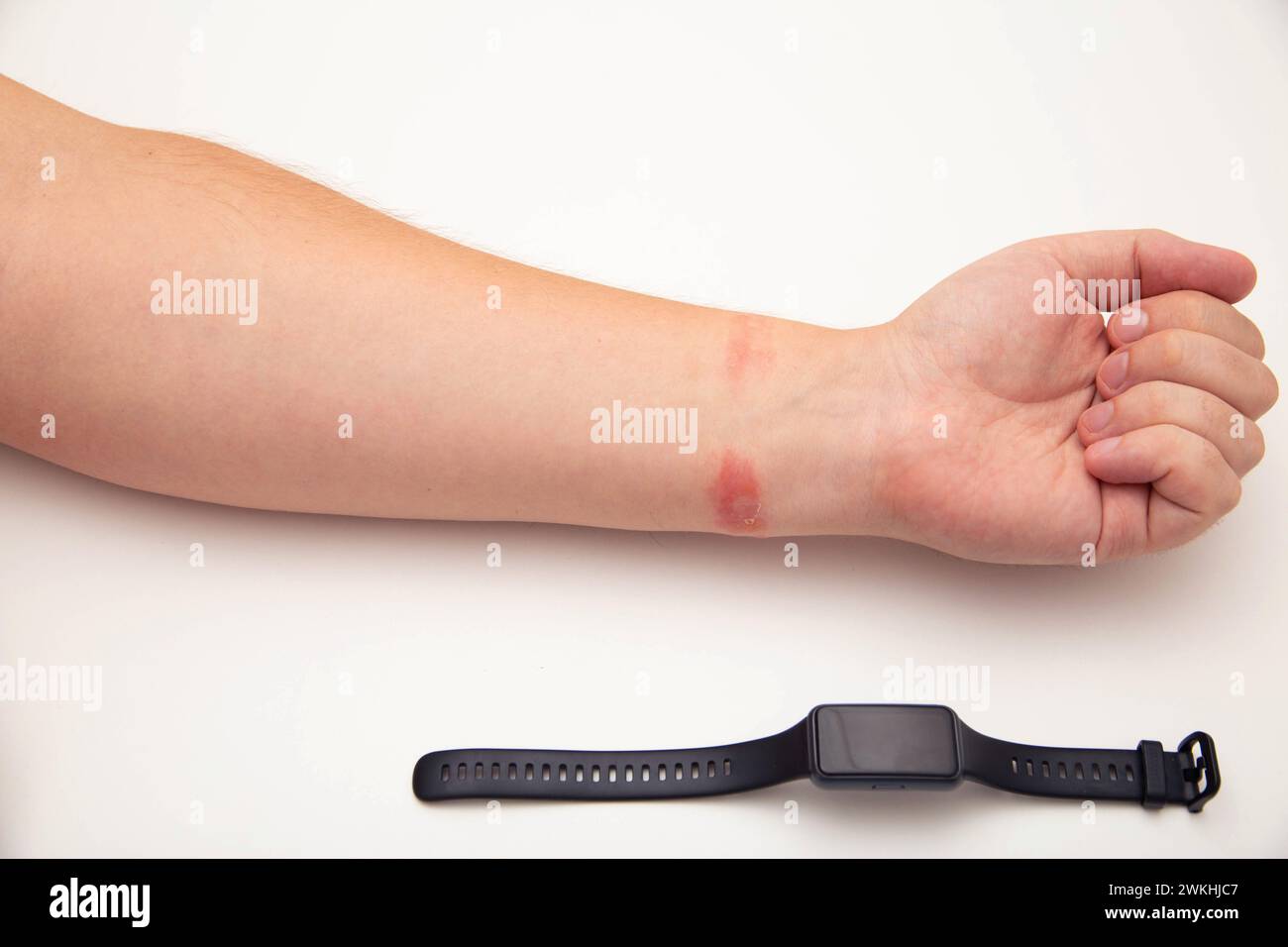 Wrist rash hi-res stock photography and images - Alamy