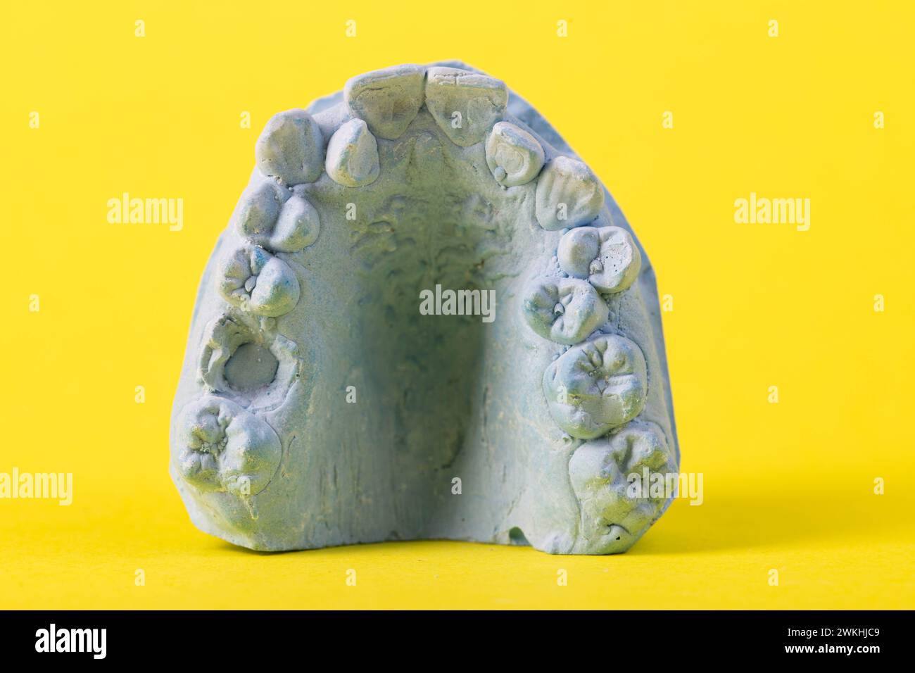 Blue plaster impression of a patient's dental jaw with crooked teeth ...