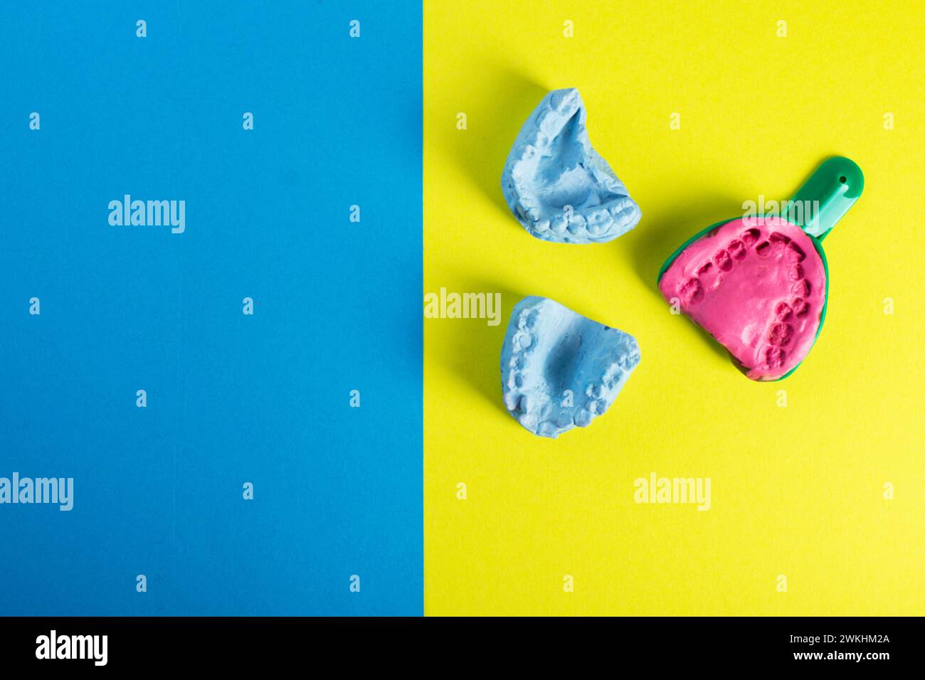 Dental tray with alginate plastic mass and blue plaster jaw of the ...