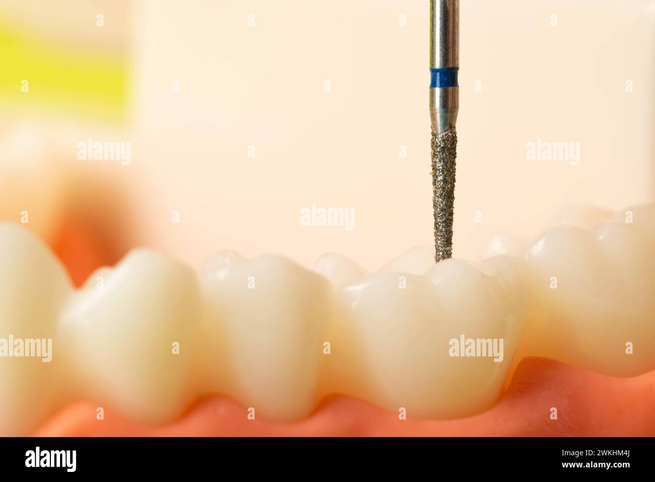 The diamond drill of the drill polishes the new filling installed on ...