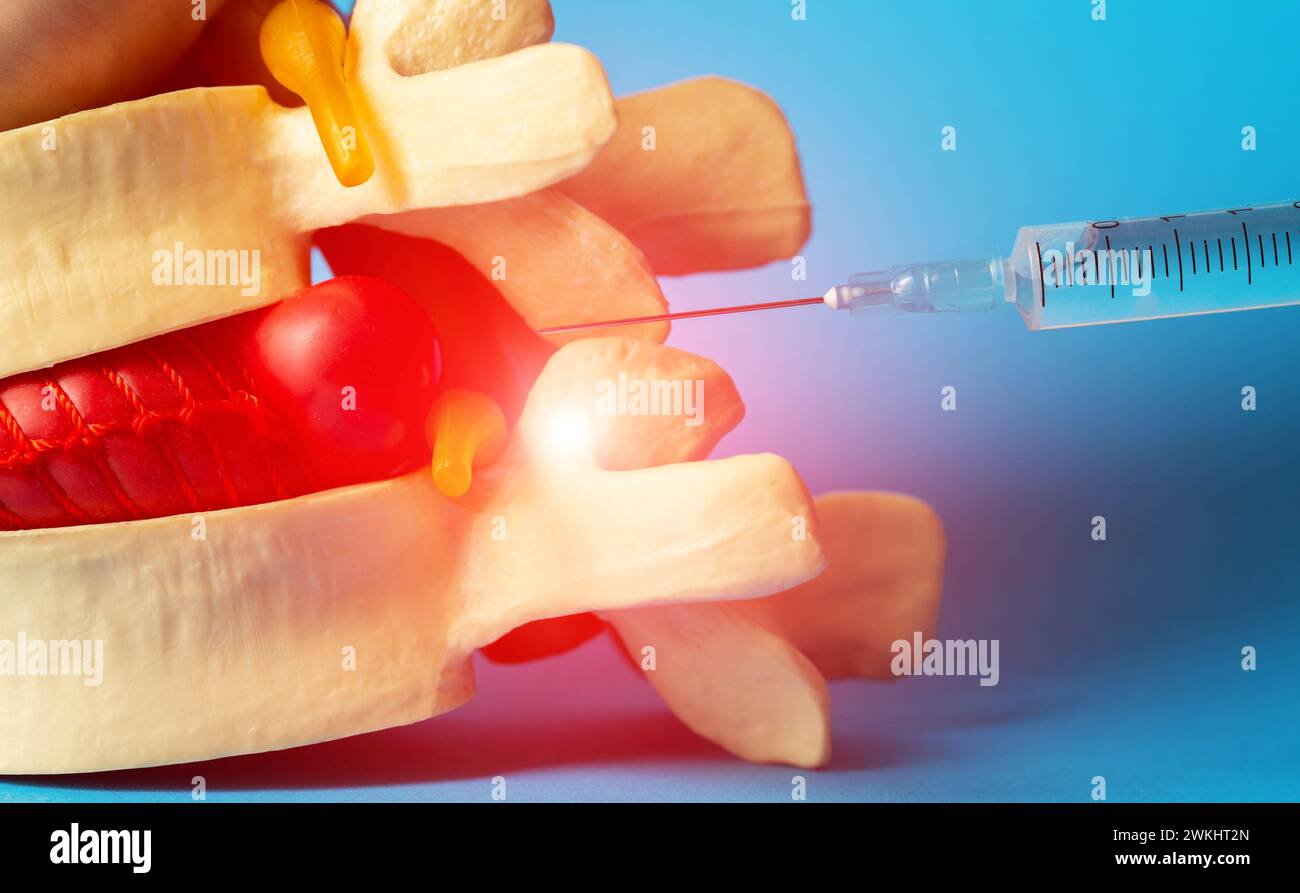 Injection into the intervertebral hernia of a medical model on a blue ...