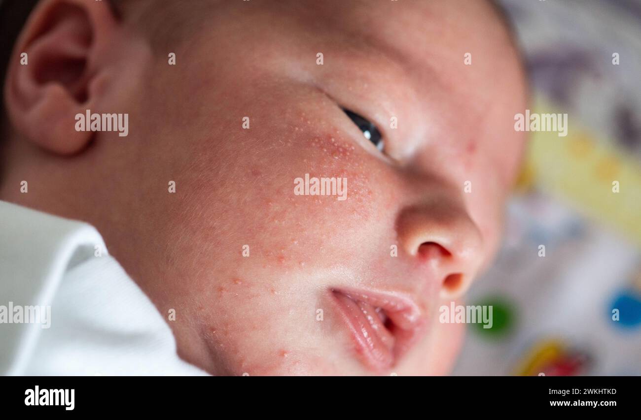 Newborn acne hi-res stock photography and images - Alamy