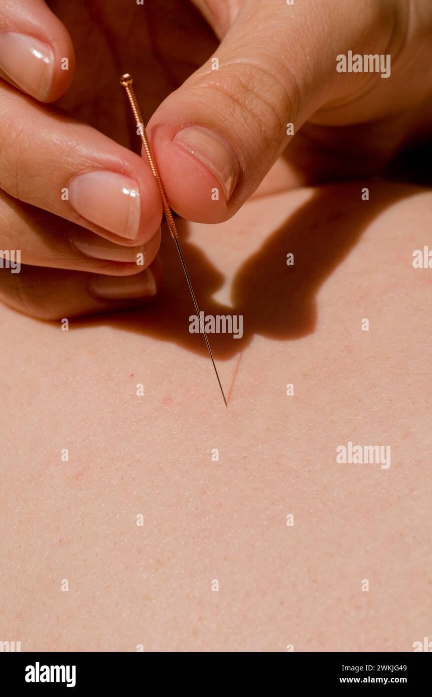Akupunkturnadel akupunktur hi-res stock photography and images - Alamy