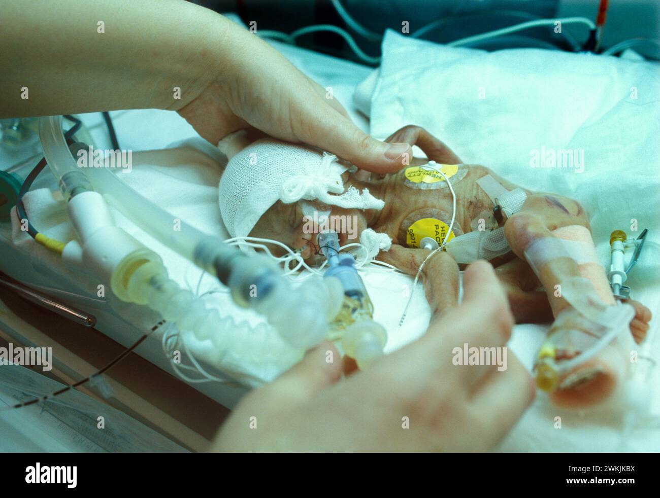 Premature Baby Unit at Nottingham General Hospital, a new born ...