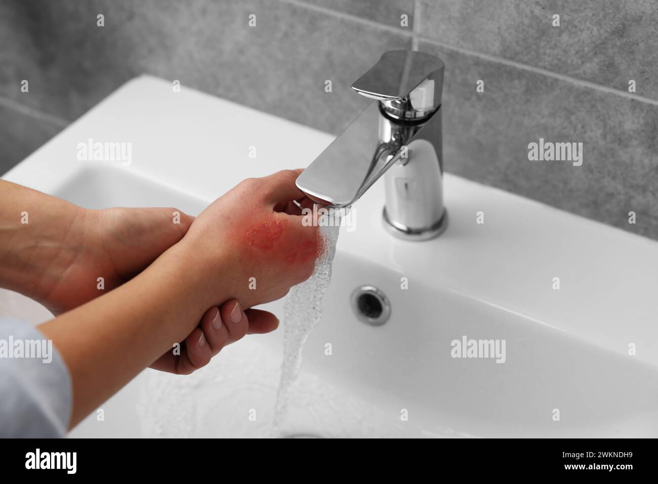 Burn skin cold water hi-res stock photography and images - Alamy