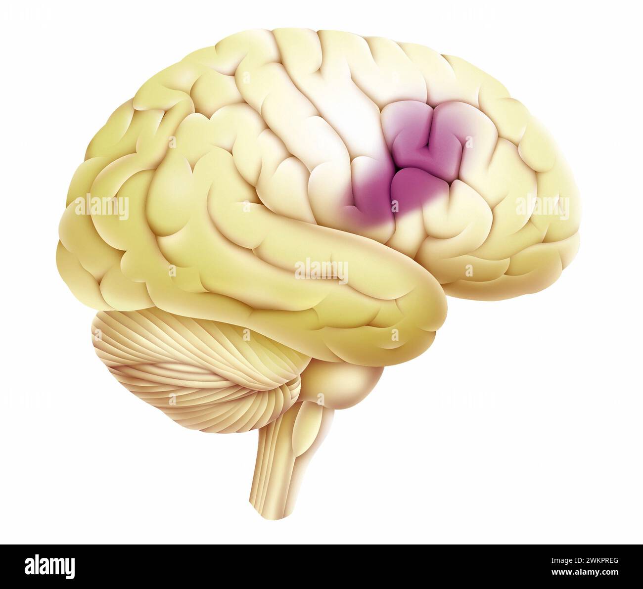 Scientific illustration brain with stroke; made by physician Stock ...