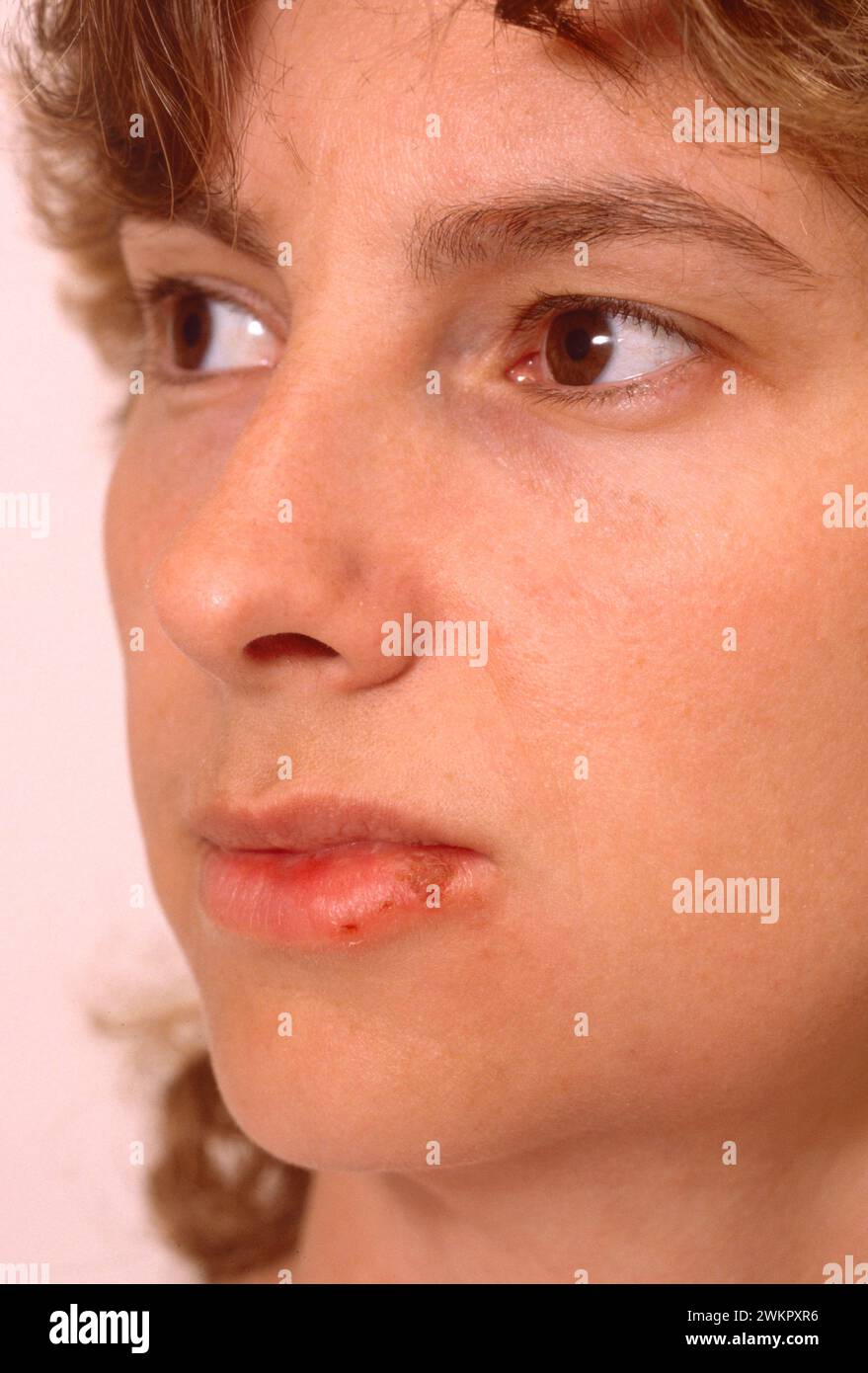 young woman looking sad with coldsores, cold-sores, erupting on her ...