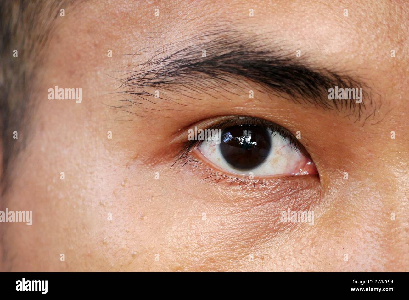 Eye hemorrhage hi-res stock photography and images - Alamy