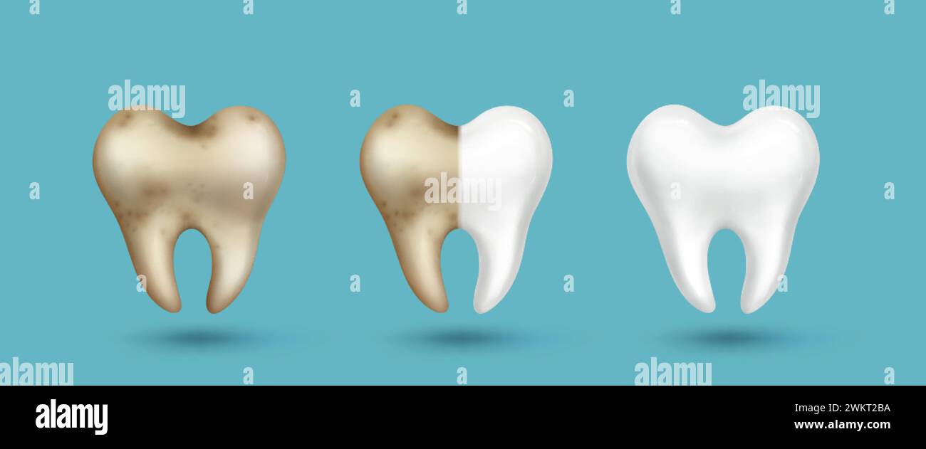 Realistic tooth before and after cleaning procedure at dentist - dirty ...