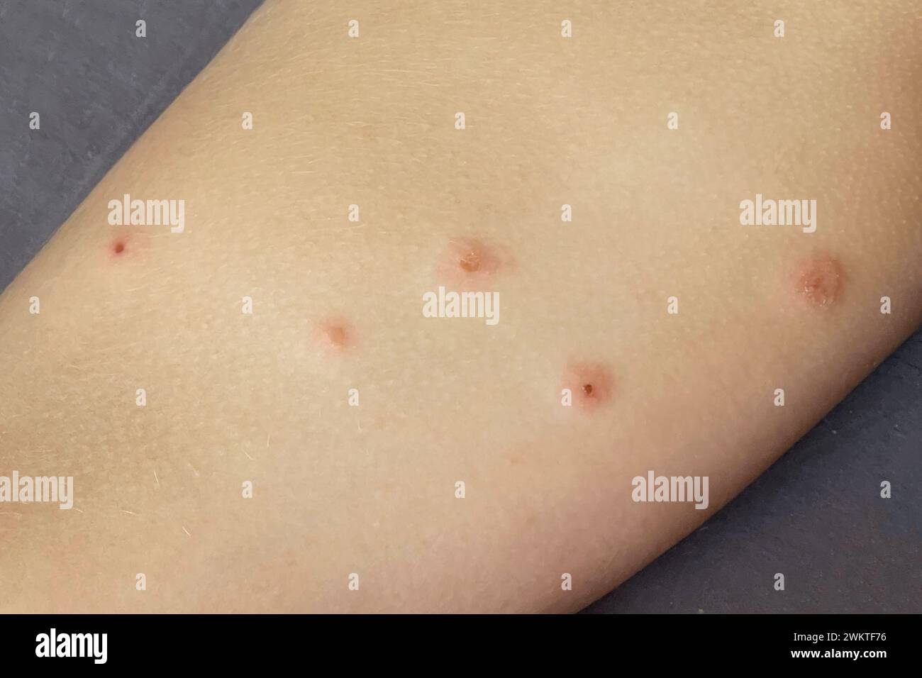 Bedbug bites. Body with skin problem. Infectious disease. Allergy ...
