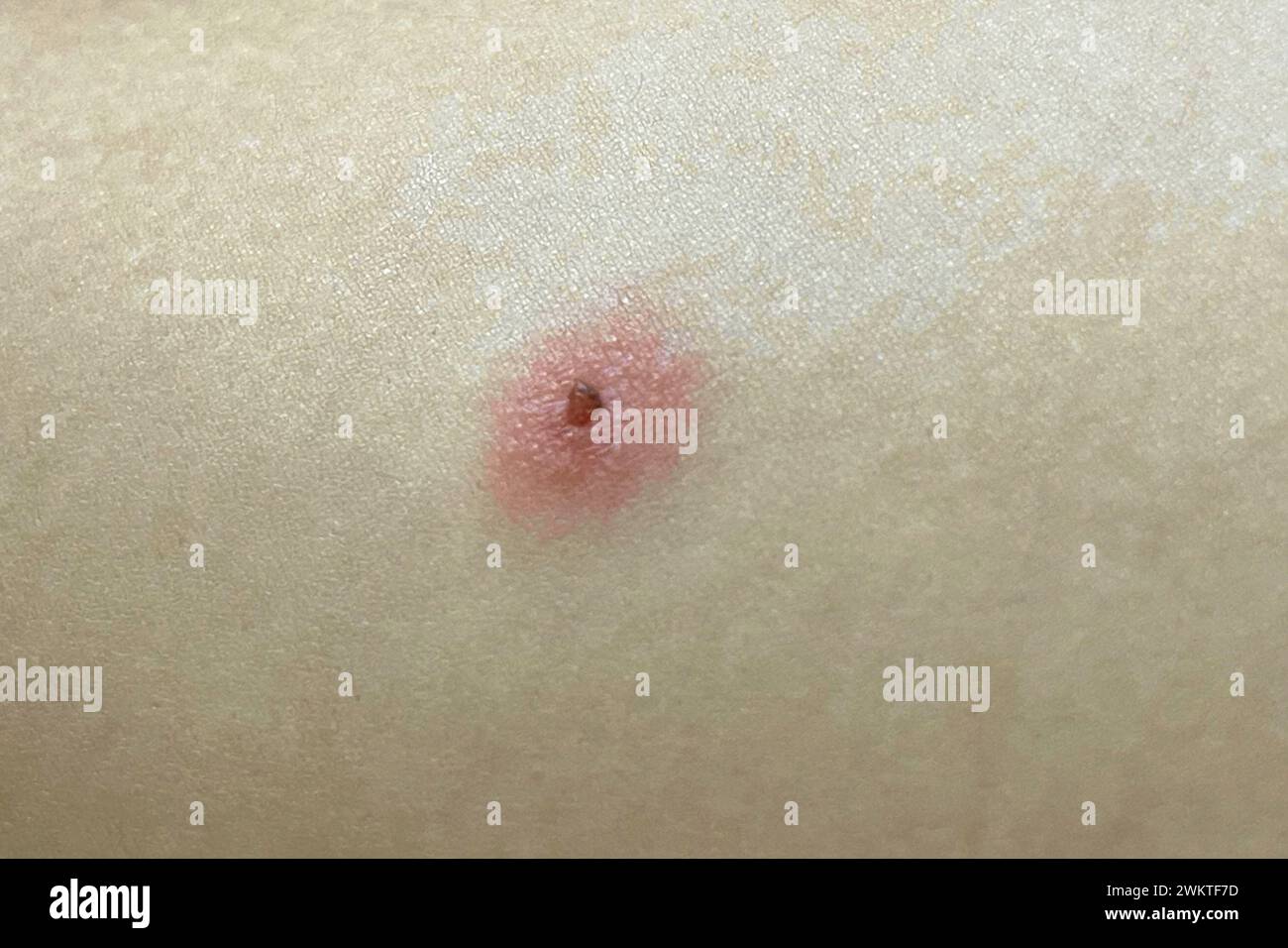 Blister closeup. Body with skin problem. Infectious disease. Allergy ...