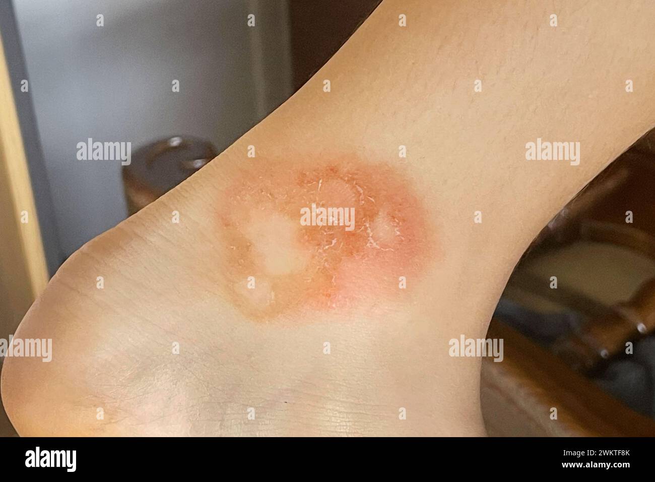 Human ankle leg closeup. Body with skin problem. Infectious disease ...