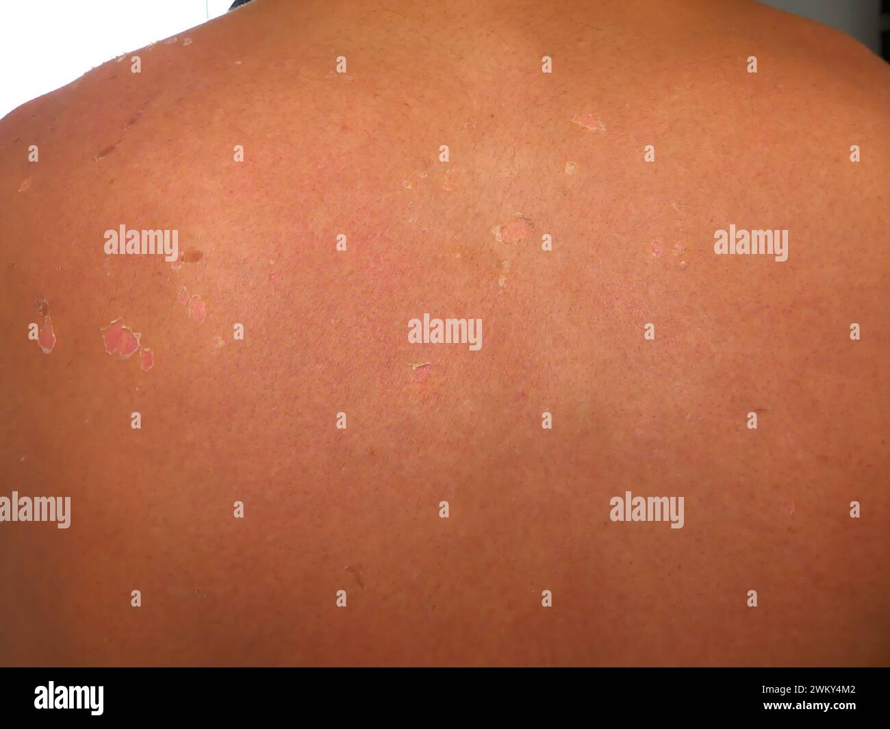 Significant epithelial erythema after long sun exposure with blisters ...