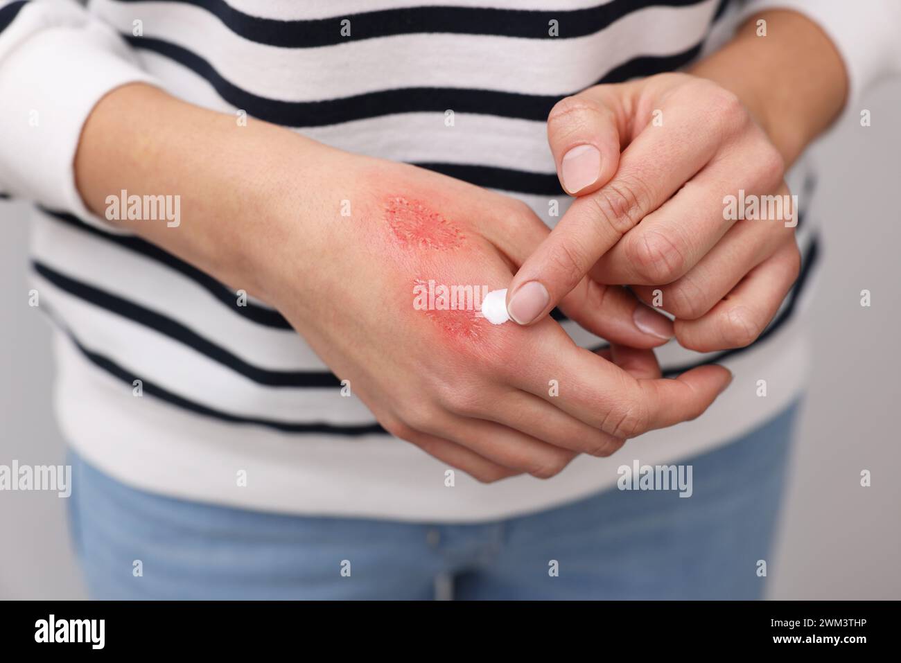 Woman applying ointment onto hi-res stock photography and images - Alamy