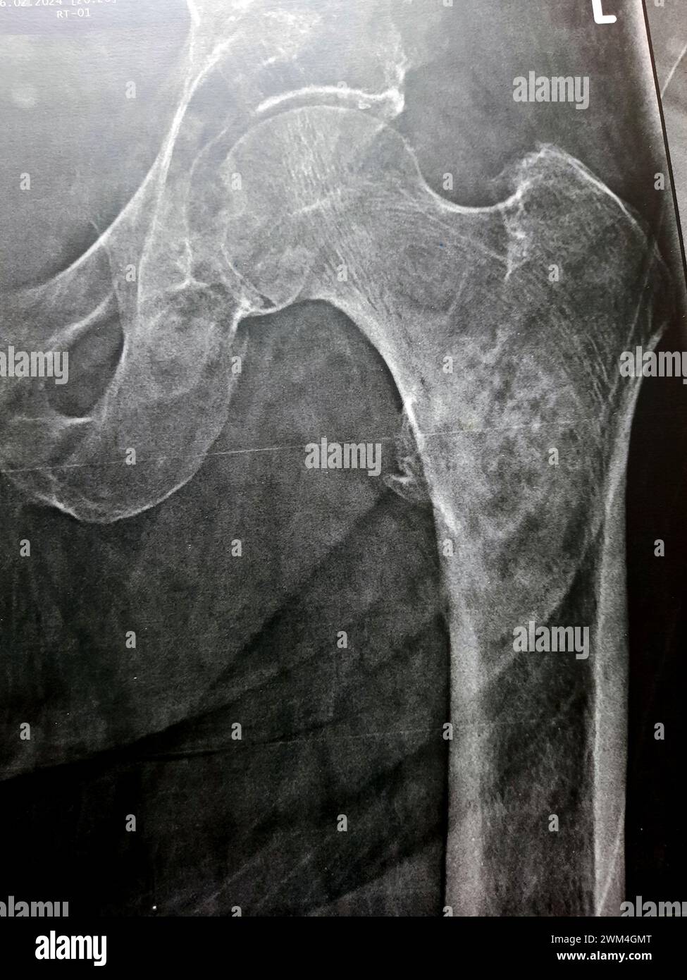 Plain x-ray with high probability of subtrochanteric, trochanteric ...