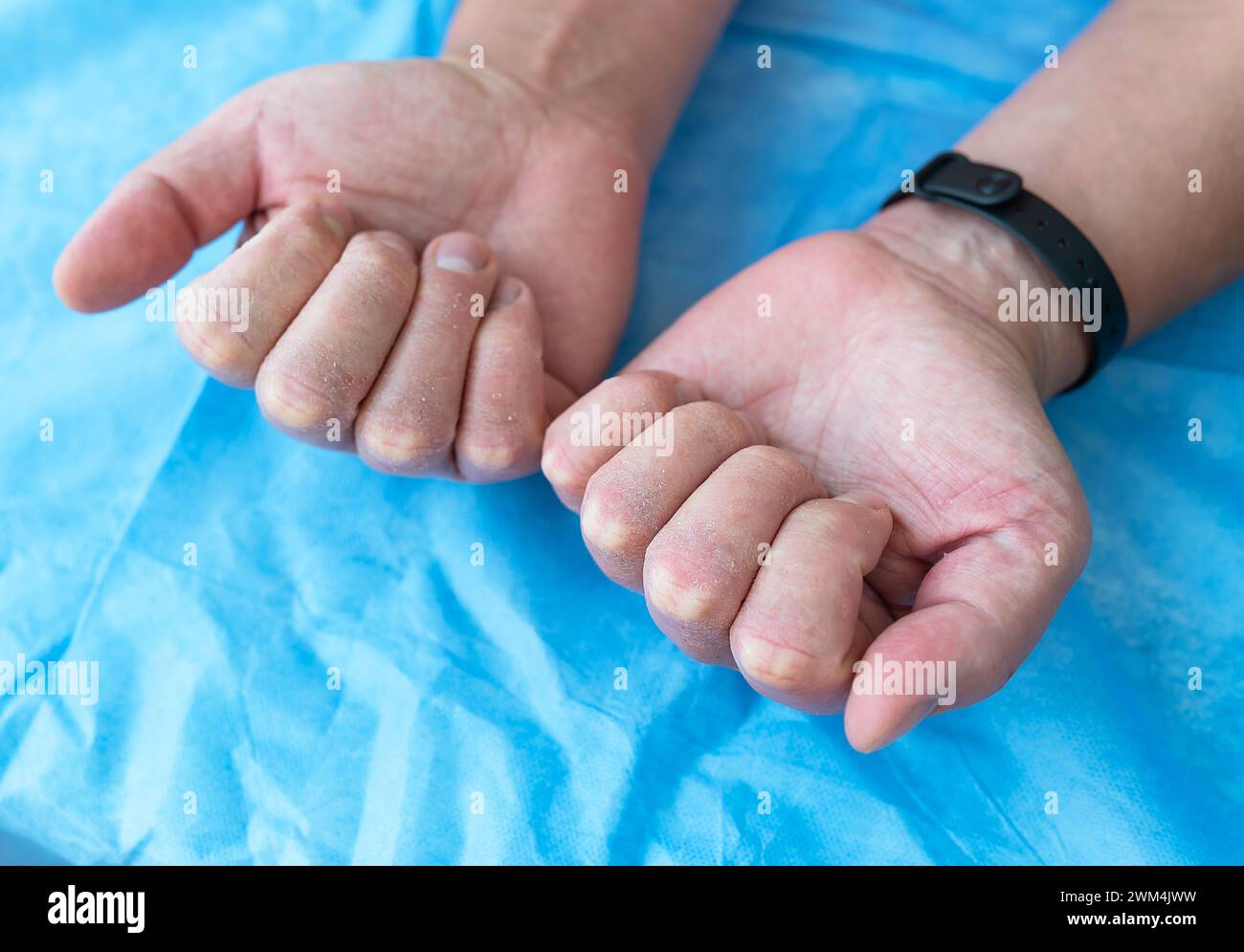 Close-up of hands with very bad skin condition, cracked skin on hands ...
