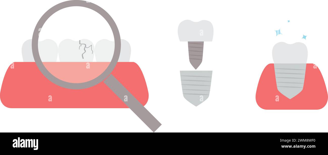 replacement of broken tooth with dental cap Stock Vector Image & Art ...