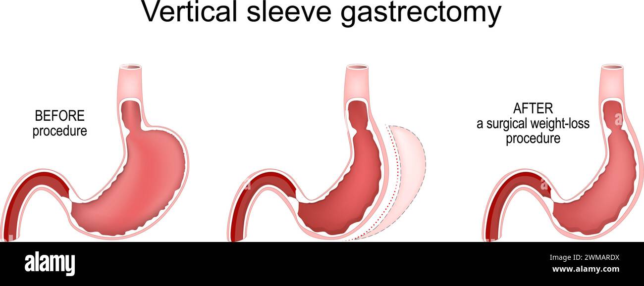 Vertical Sleeve Gastrectomy. Stomach before and after a surgical weight ...