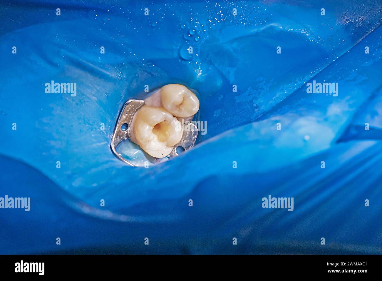 Dental dam application hi-res stock photography and images - Alamy