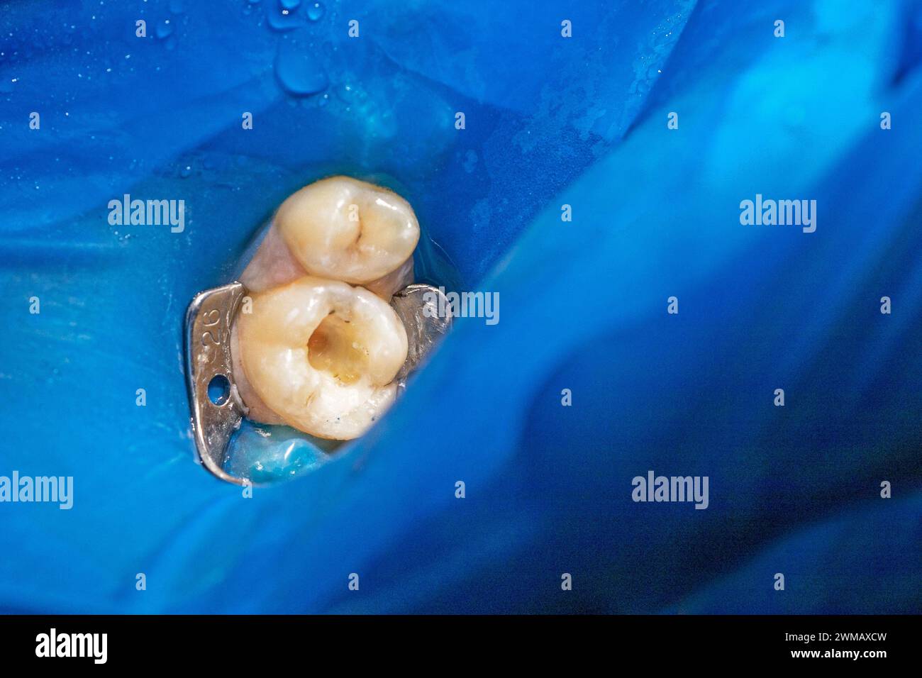 restoration of a damaged tooth at the dentist. Care and care of teeth ...