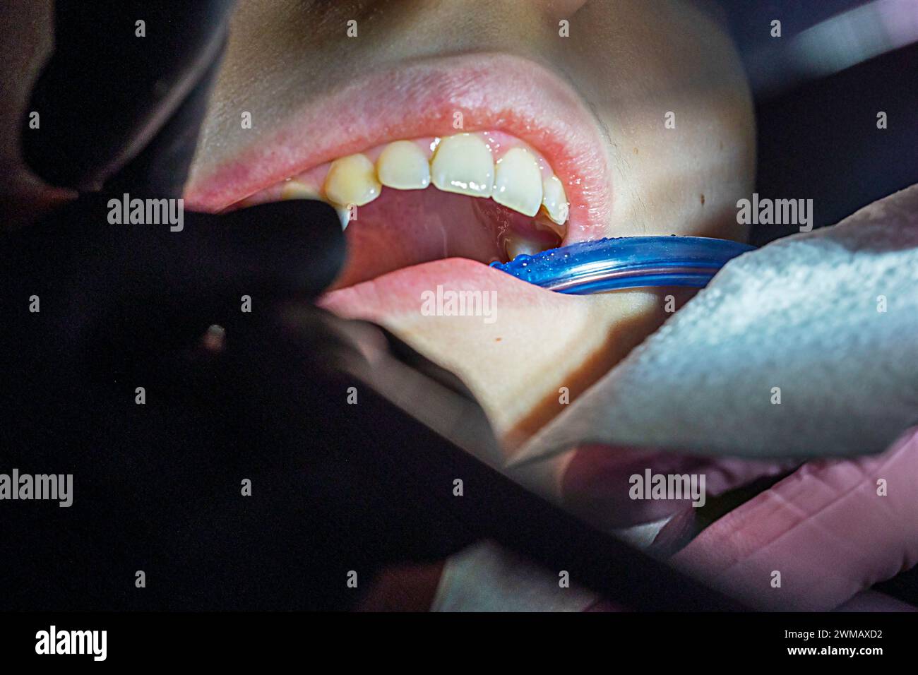 dentist uses a special instrument to restore a tooth. Dental care and ...