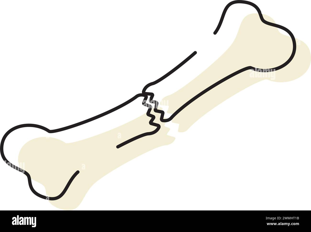 Medical broken bone hi-res stock photography and images - Alamy