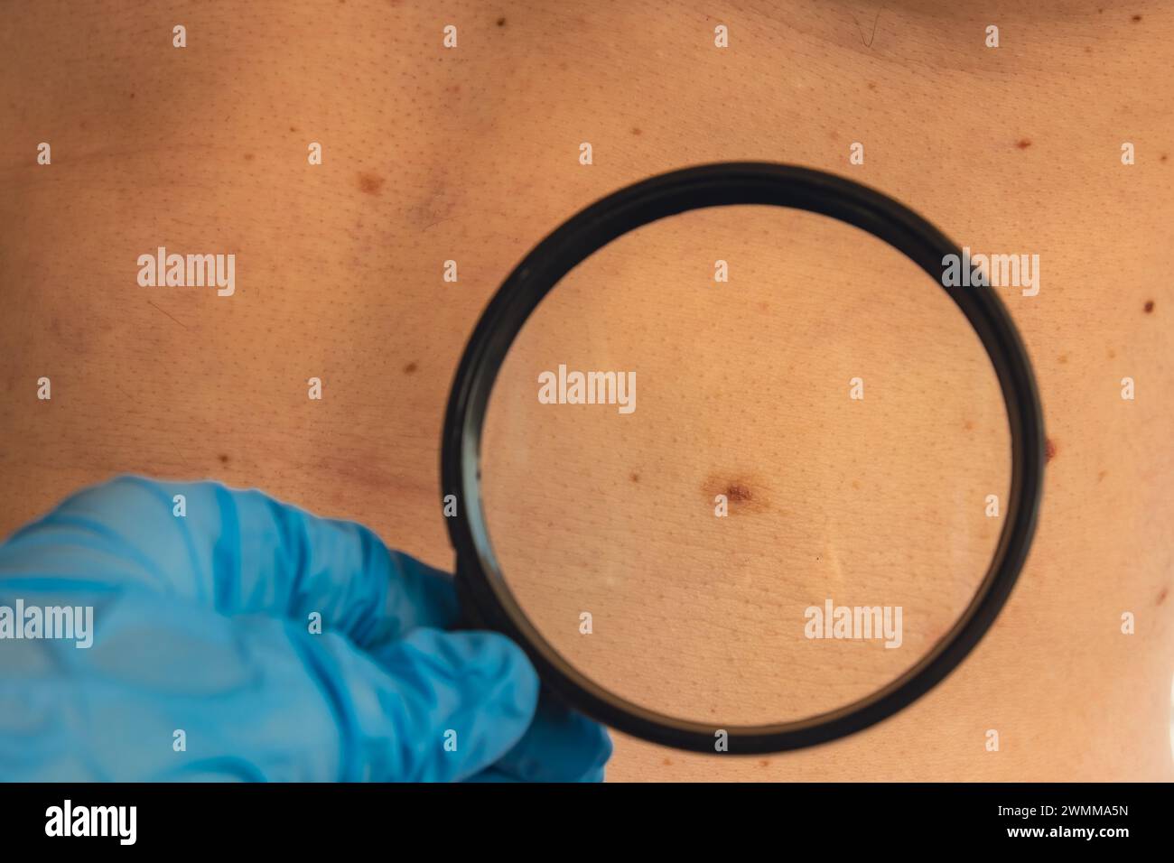Mole dermoscopy, preventive of melanoma. Dermatologist examining ...