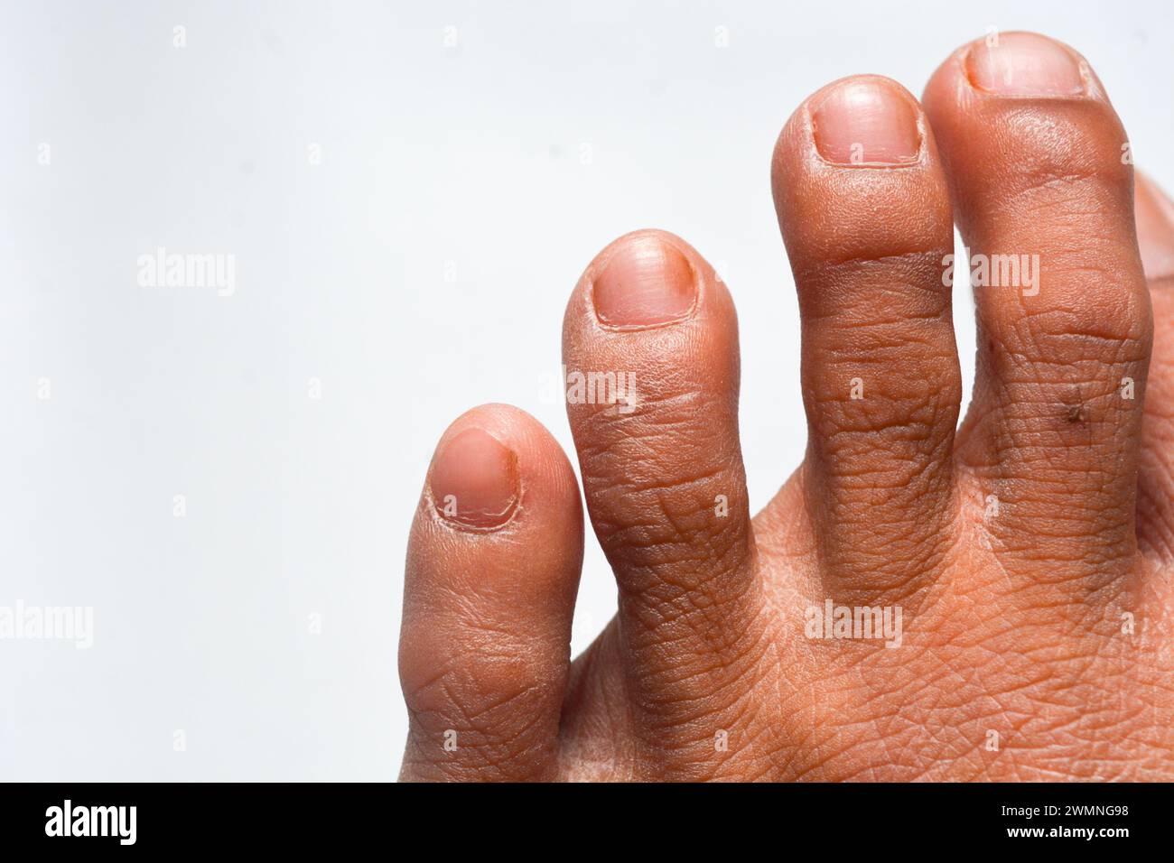 Close up photo of itchy and sore leg area, photo about health Stock ...