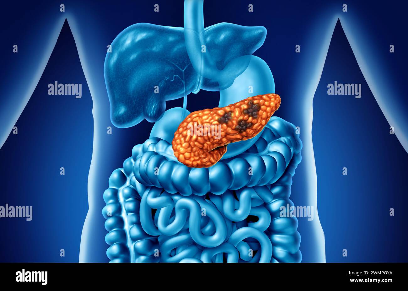 Pancreatic Cancer Anatomy Concept And Pancreas Malignant Tumor Symbol