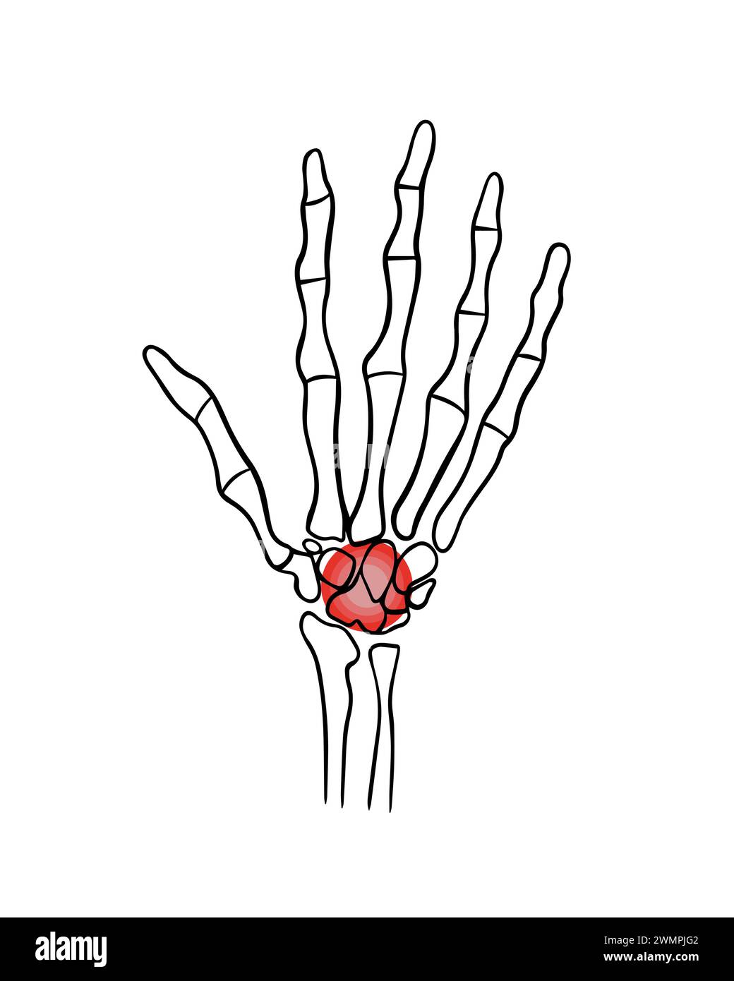 Vector isolated illustration of wrist pain. Hand with localization of ...