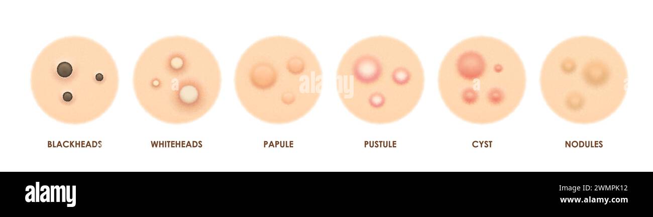 Body Skin Acne Types Pimples And Papules Pore Inflammation And
