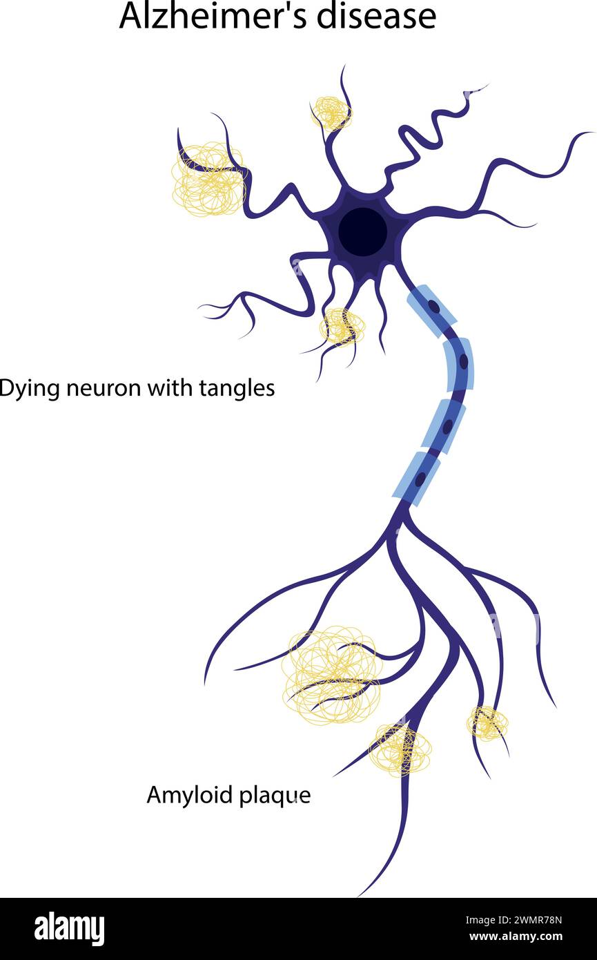 Damaged neuron. The structure of a diseased neuron. Alzheimers disease ...