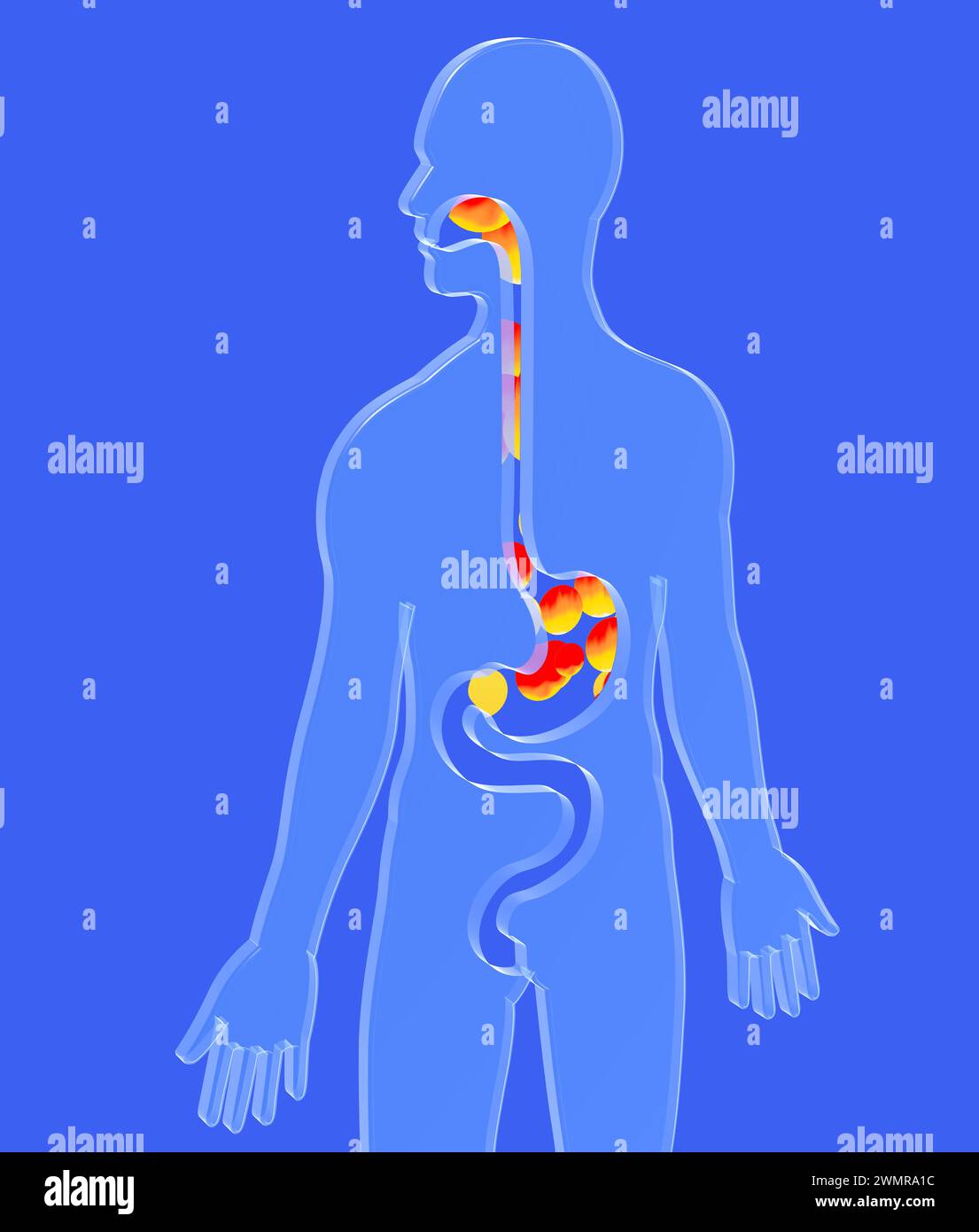 3d illustration of esophagus with gastric reflux and heartburn. With ...