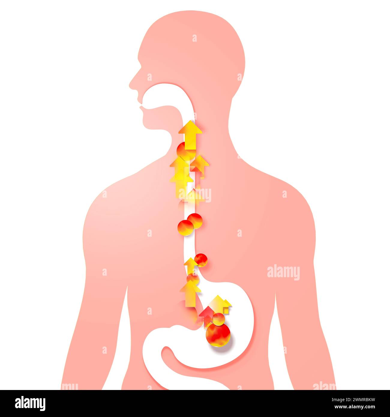 3d illustration of esophagus with gastric reflux and heartburn. With ...