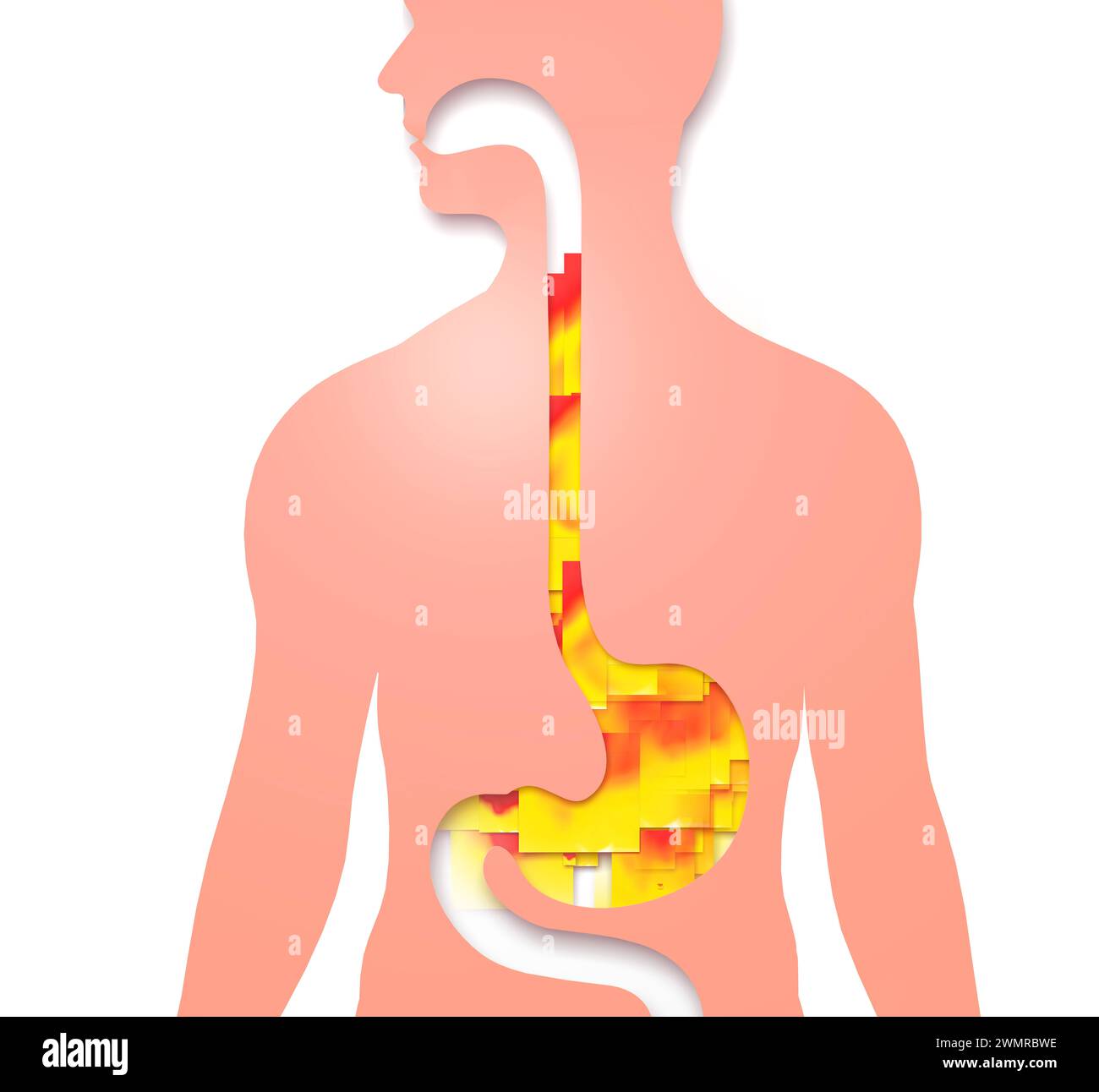 3d illustration of esophagus with gastric reflux and heartburn. With ...