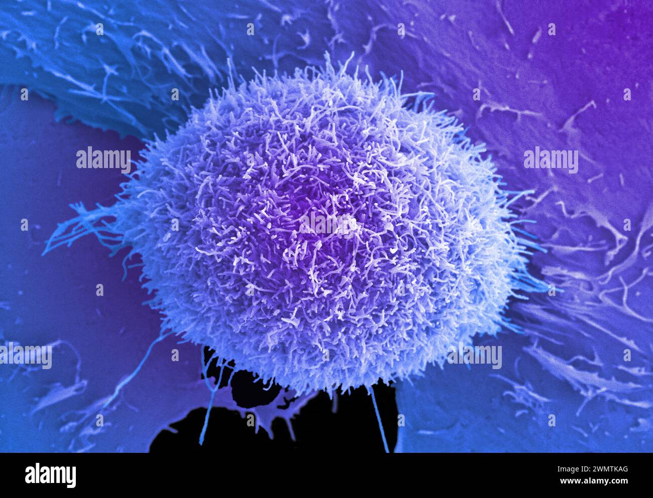 Cervical cancer cells, SEM Stock Photo - Alamy