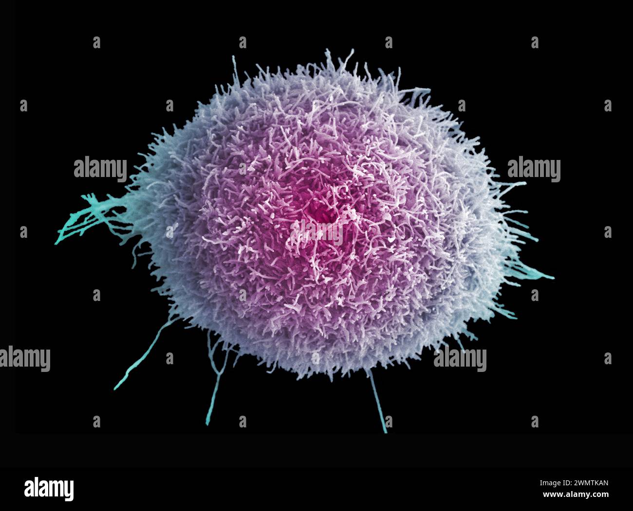Cervical cancer cell, SEM Stock Photo - Alamy