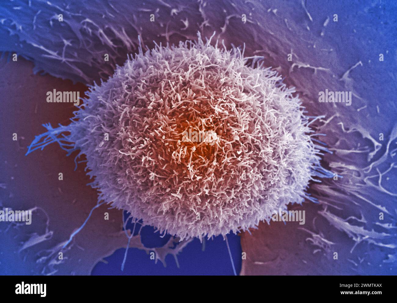 Cervical cancer cells, SEM Stock Photo - Alamy