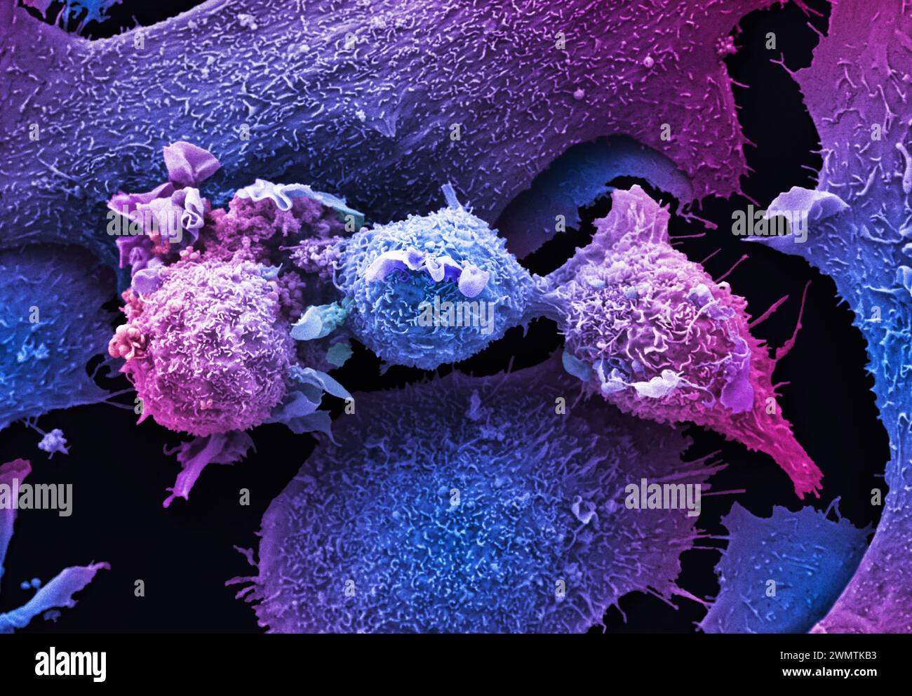 Lung cancer cells, SEM Stock Photo - Alamy