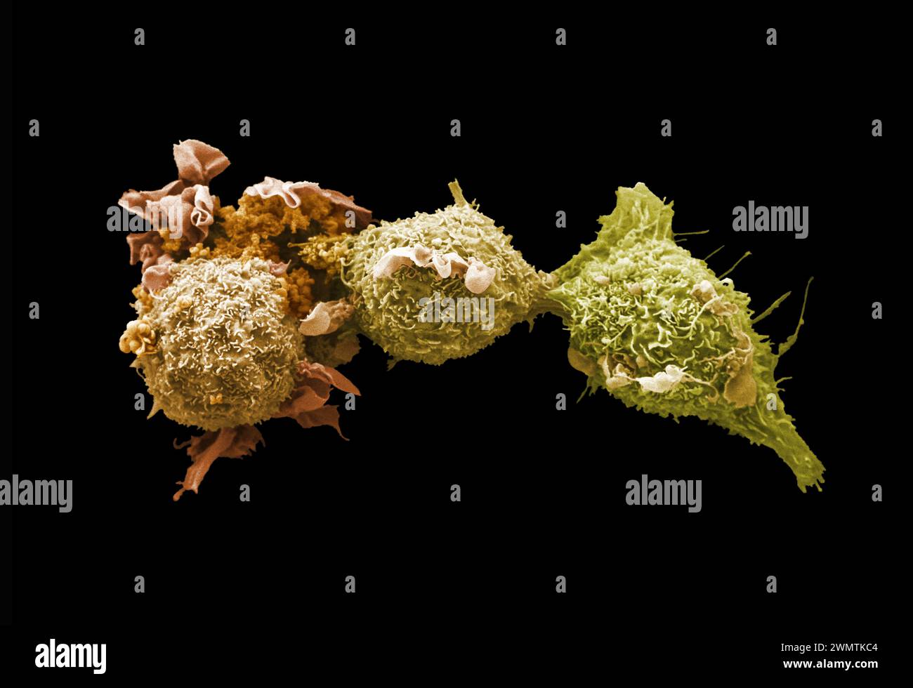 Lung cancer cells, SEM Stock Photo - Alamy