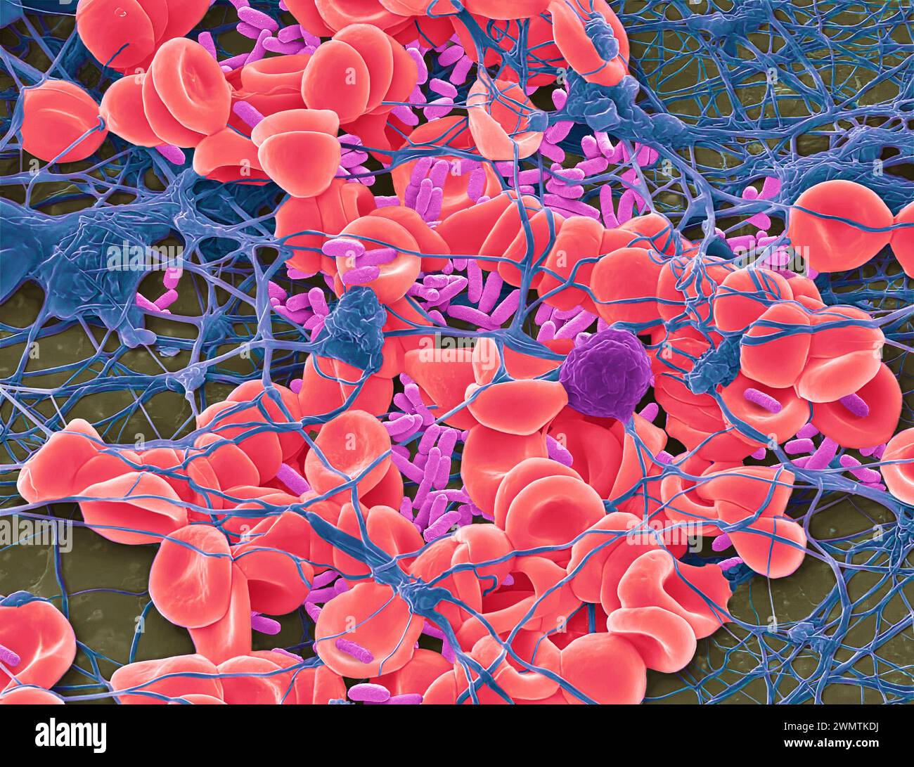 Sepsis. Composite coloured scanning electron micrograph (SEM) of sepsis ...