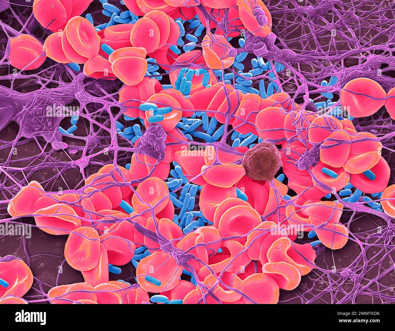 Sepsis. Composite coloured scanning electron micrograph (SEM) of sepsis ...