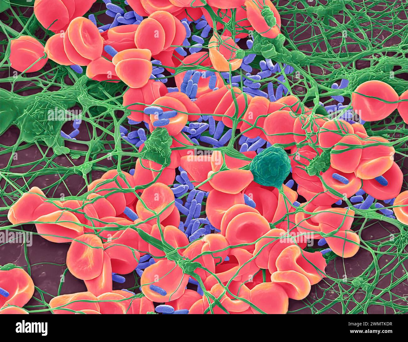 Sepsis. Composite coloured scanning electron micrograph (SEM) of sepsis ...