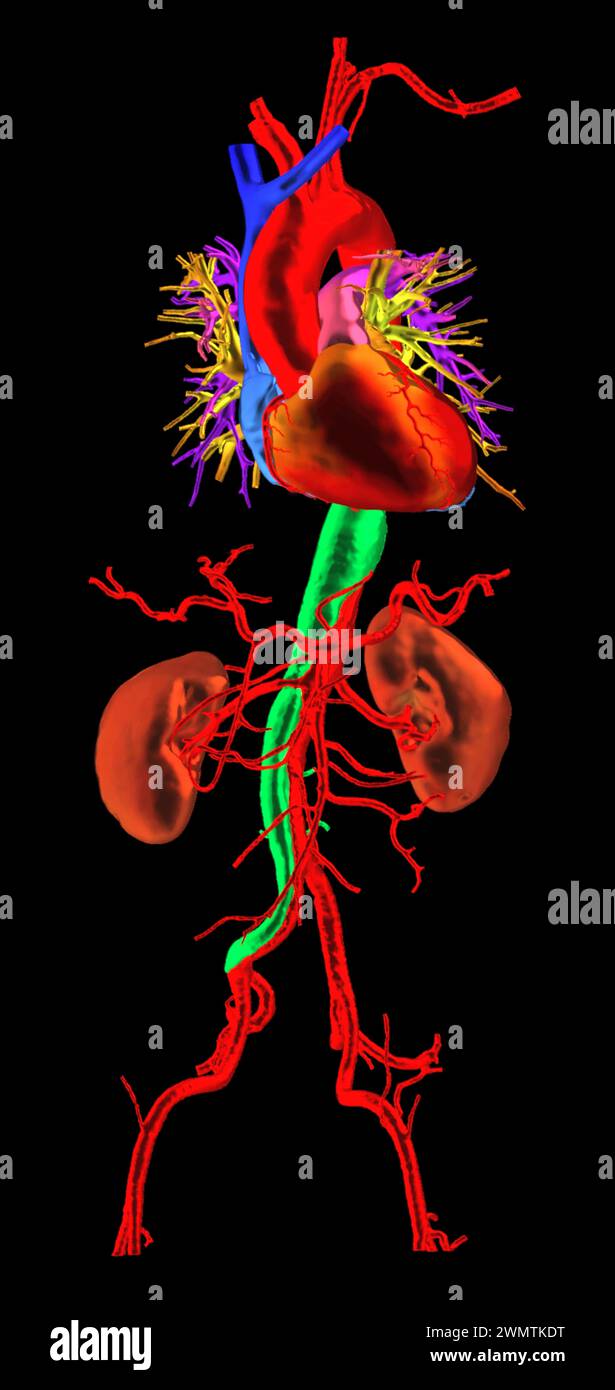 Aortic dissection, CT scan Stock Photo - Alamy