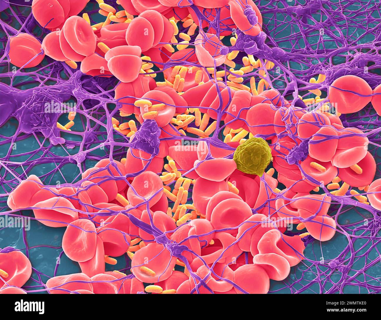 Sepsis. Composite coloured scanning electron micrograph (SEM) of sepsis ...