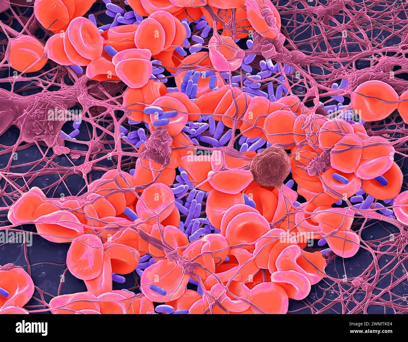 Sepsis. Composite coloured scanning electron micrograph (SEM) of sepsis ...