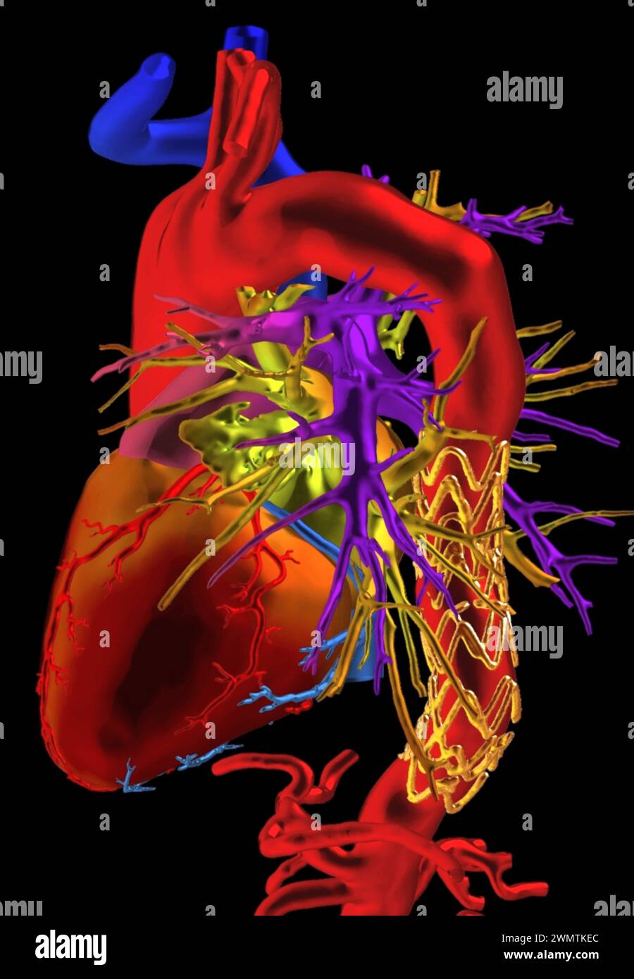 Aortic aneurysm stent, CT scan Stock Photo - Alamy