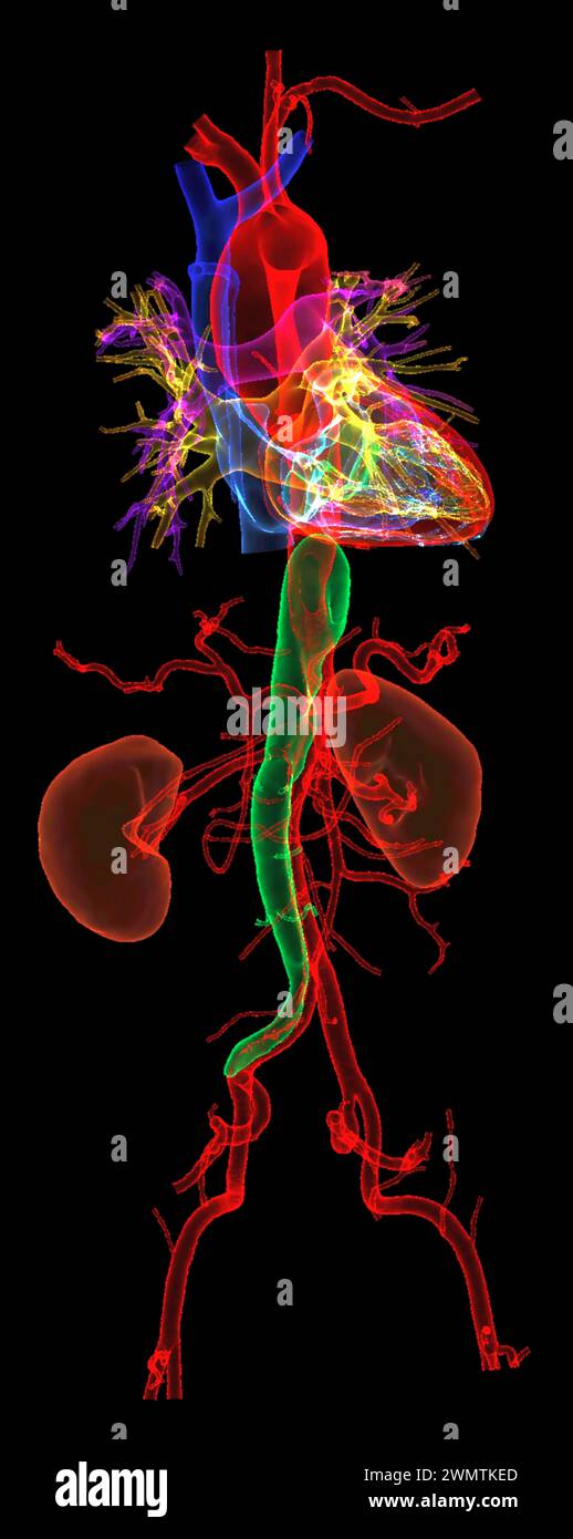 Aortic dissection, CT scan Stock Photo - Alamy