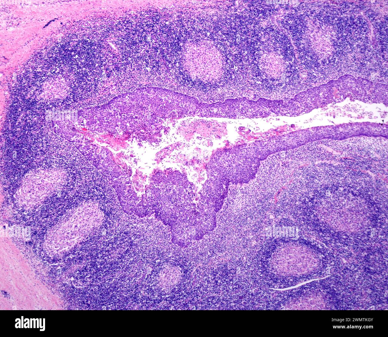 Human palatine tonsil crypt, light micrograph Stock Photo - Alamy