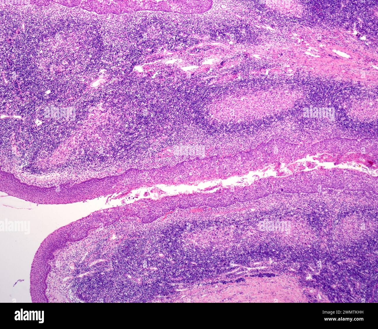 Human palatine tonsil crypt, light micrograph Stock Photo - Alamy